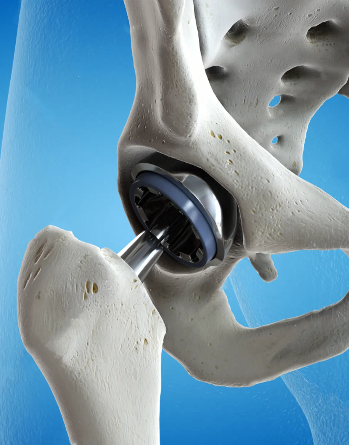 Protesi d’anca bilaterale: unico intervento per l’artrosi